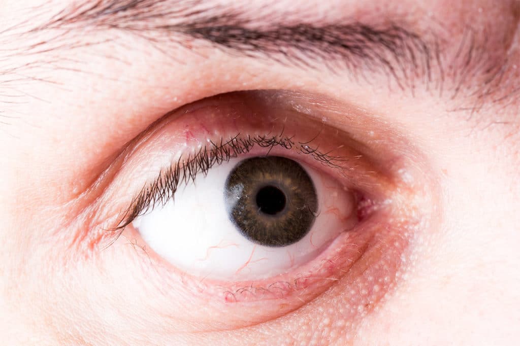 Augenprothesen für eine verbesserte Gesichtsästhetik - Operation.net