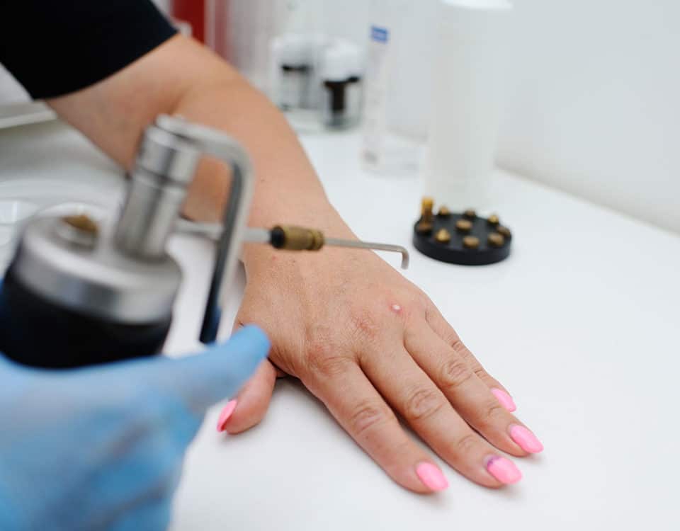 Die Warzenentfernung in verschiedenen Varianten - Operation.net